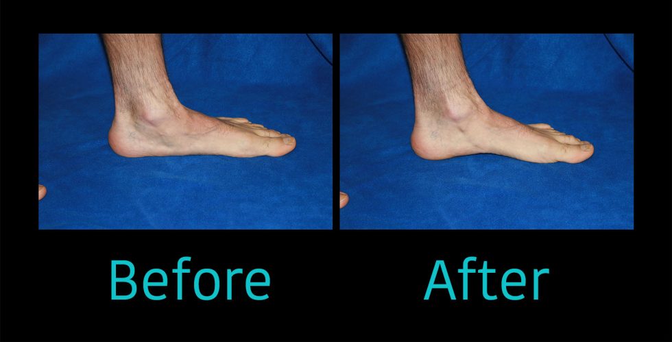 Plantar Neuropathy - GraMedica