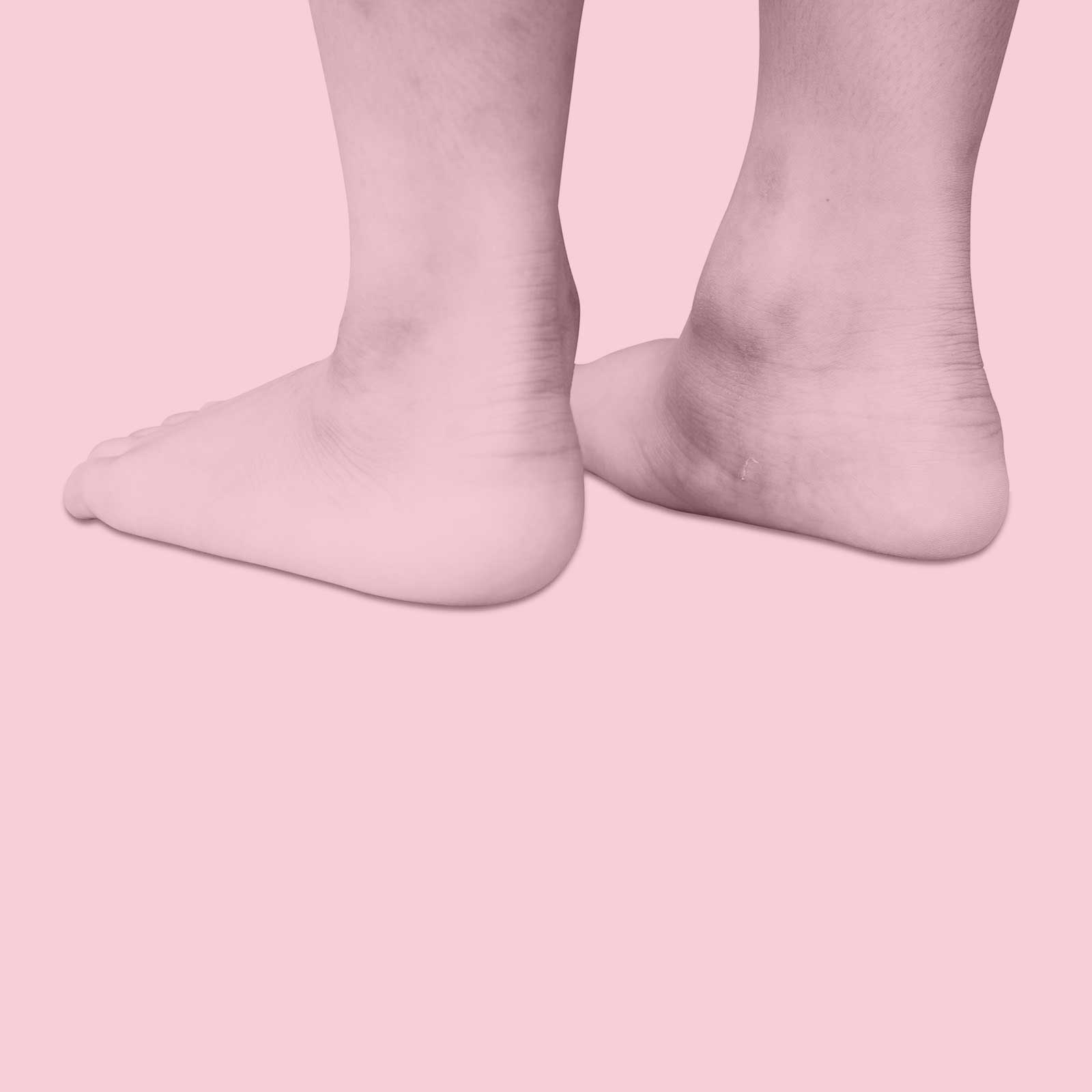 Pediatric Flat Feet - GraMedica