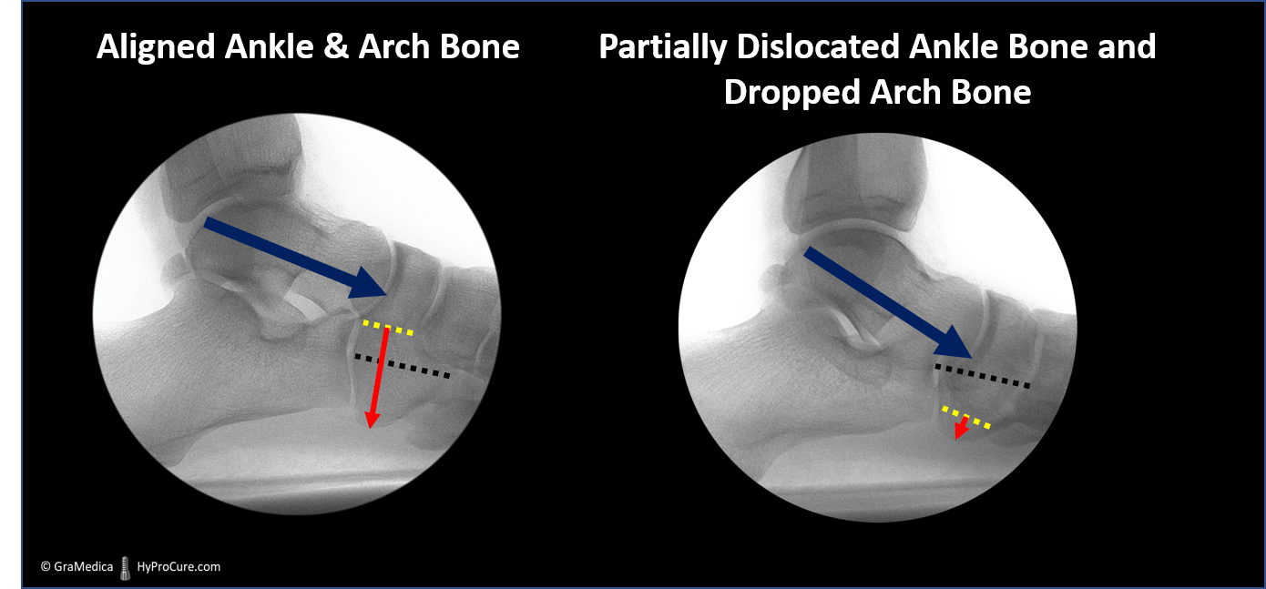 Flat feet/fallen arches - GraMedica