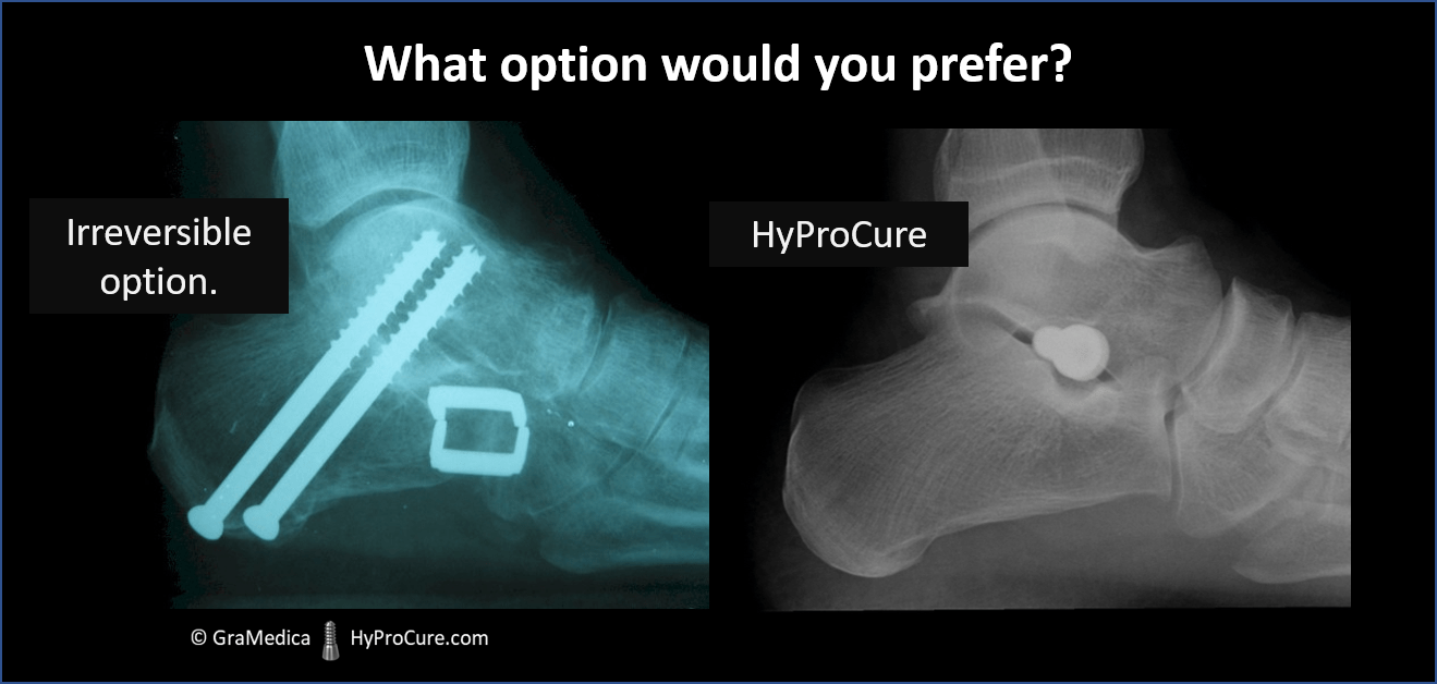 Flat feet/fallen arches - GraMedica