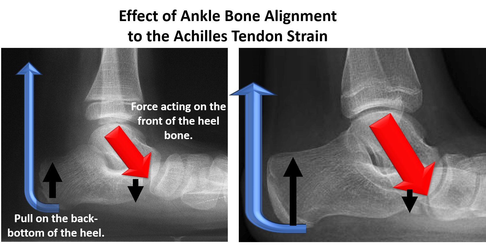 Calf Muscle – Equinus - GraMedica