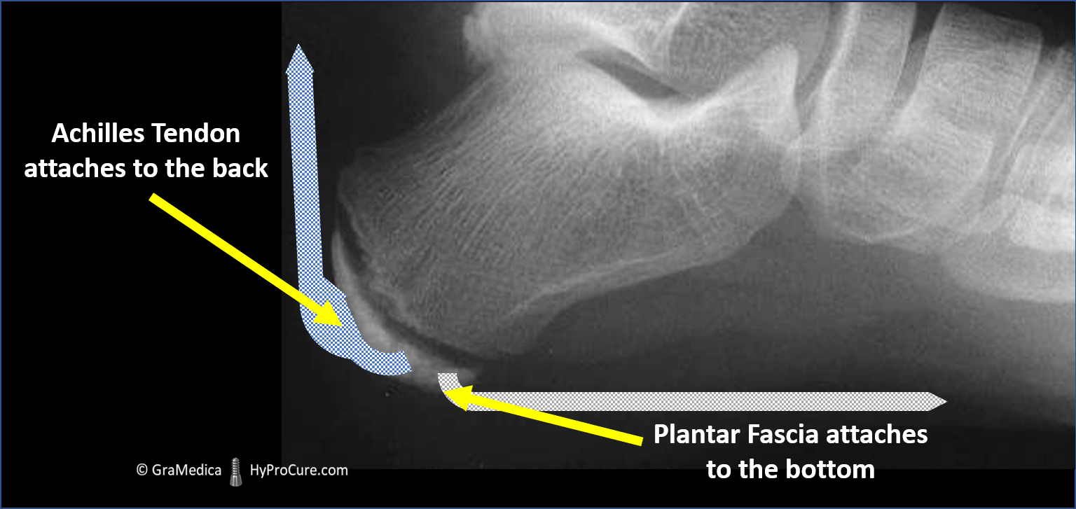 Heel pain – pediatric/Sever’s Disease/Calcaneal Apophysitis - GraMedica