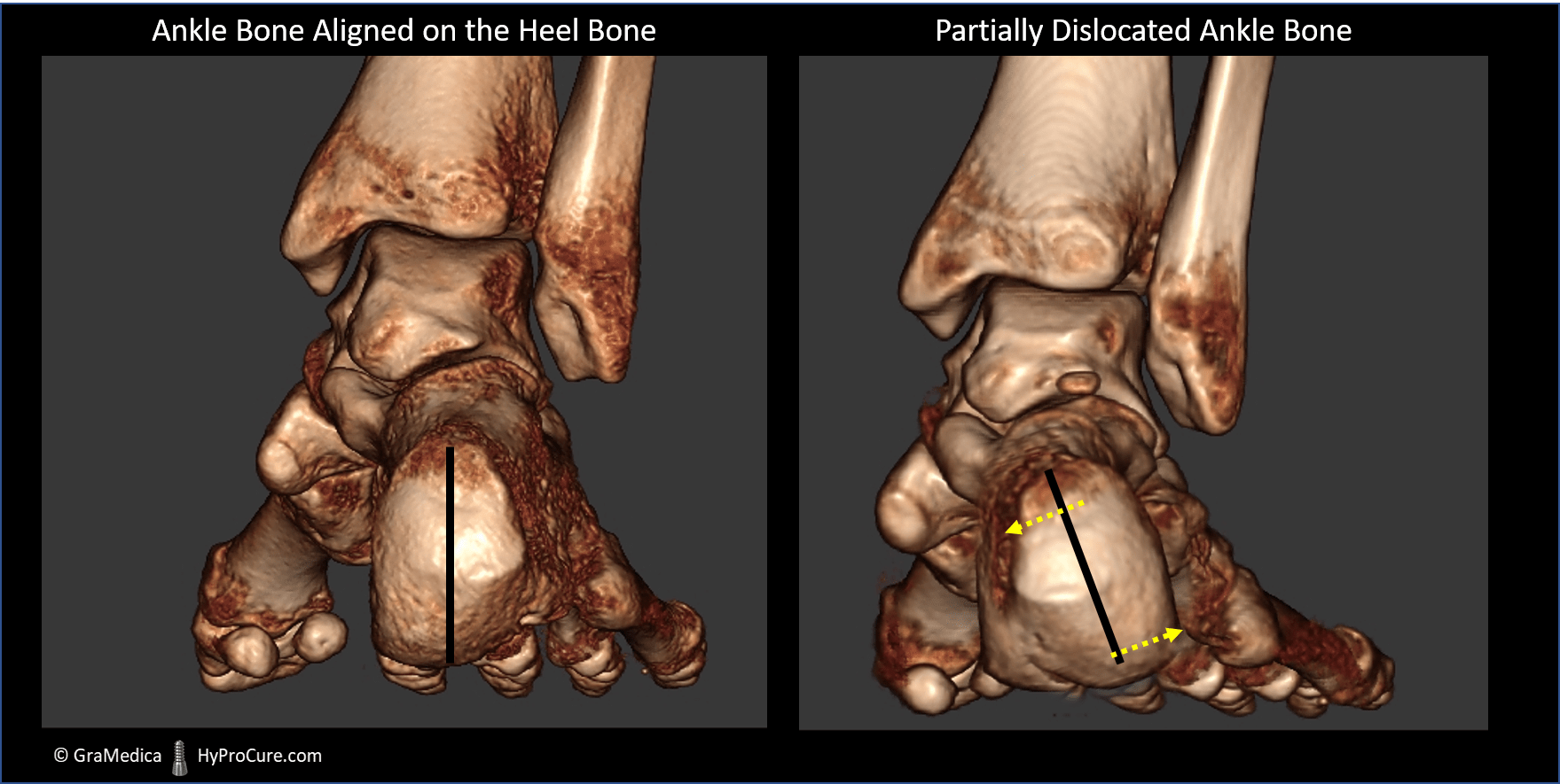 Heel pain – pediatric/Sever’s Disease/Calcaneal Apophysitis - GraMedica