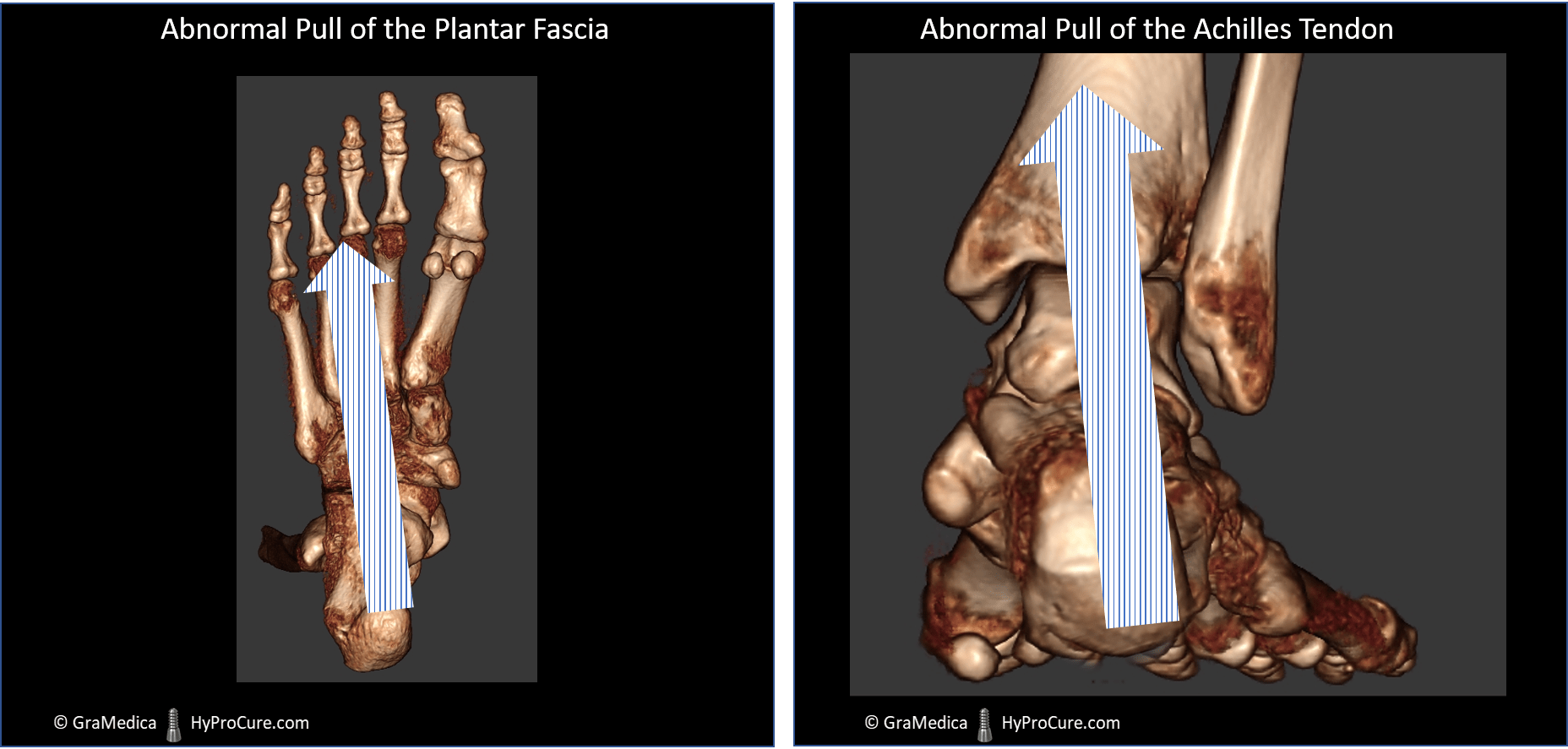 Heel pain – pediatric/Sever’s Disease/Calcaneal Apophysitis - GraMedica